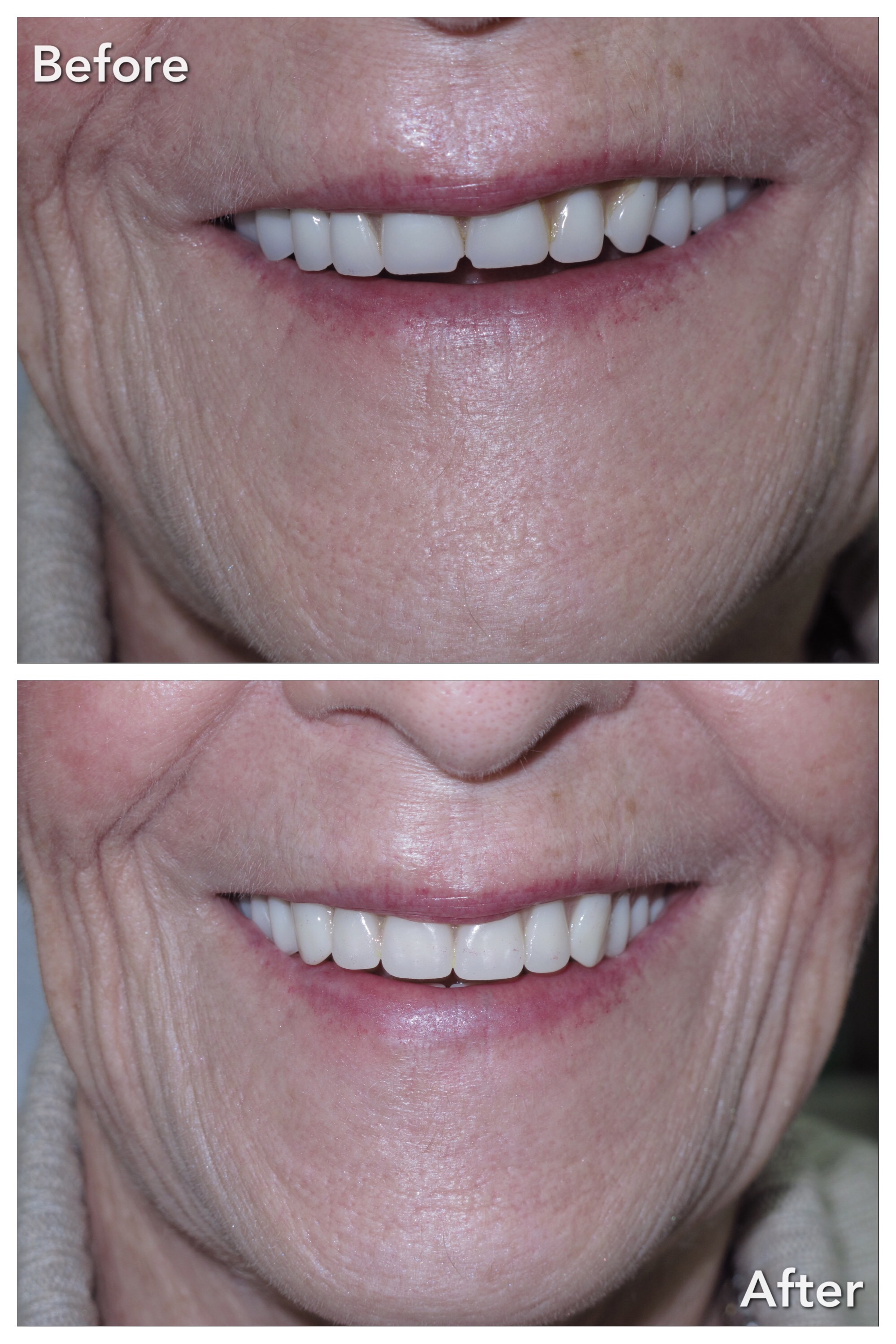 Complete Upper & Lower Treatment - Baker Lanoue Denture Clinic